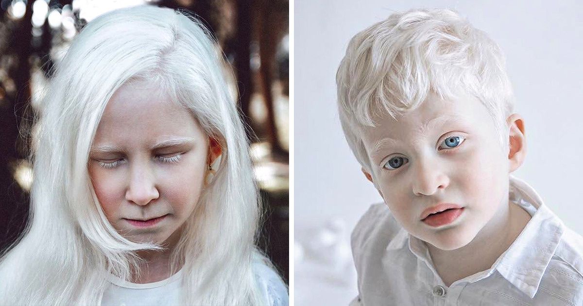 A Photographer Captures People With Albinism To Show Their Stunning And