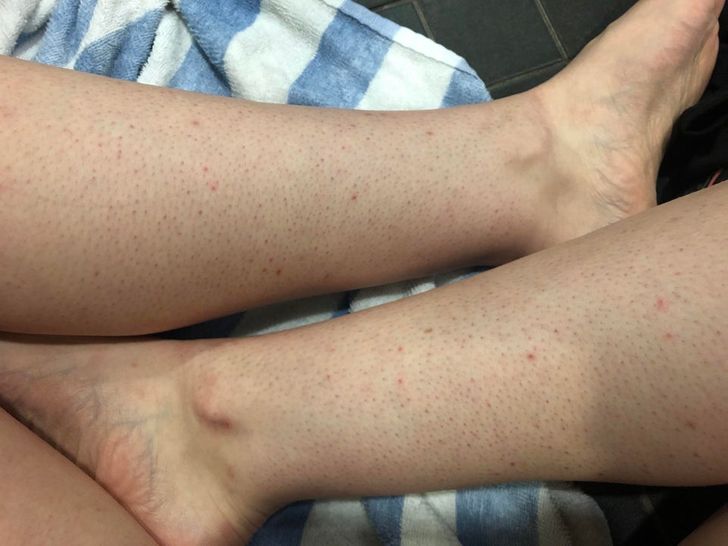 What Causes Strawberry Legs And How To Get Rid Of It Bright Side What Causes Strawberry Legs And How To Get Rid Of It Bright Side