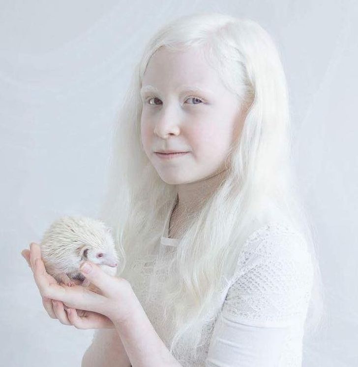 A Photographer Captures People With Albinism To Show Their Stunning And